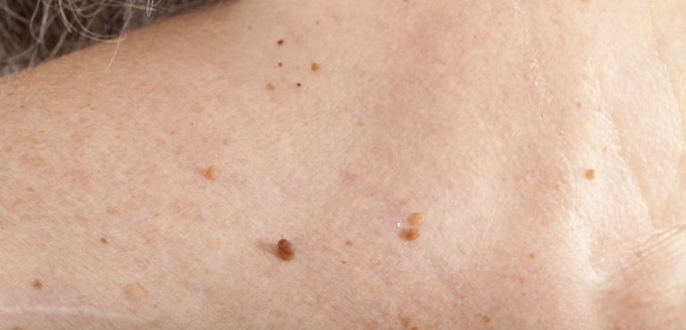 SKIN TAG REMOVAL - Vail | Aspen | Basalt | Glenwood Dermatology