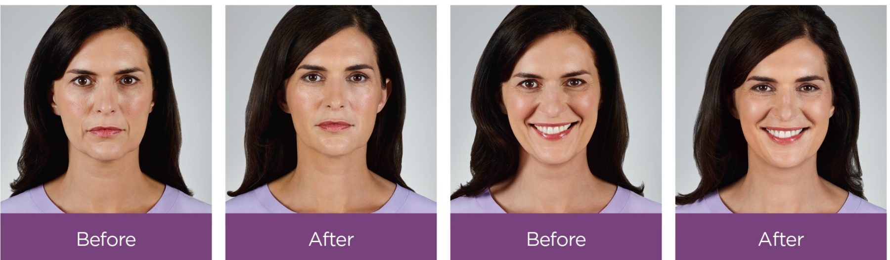 INJECTABLE FILLERS - Vail | Aspen | Basalt | Glenwood Dermatology