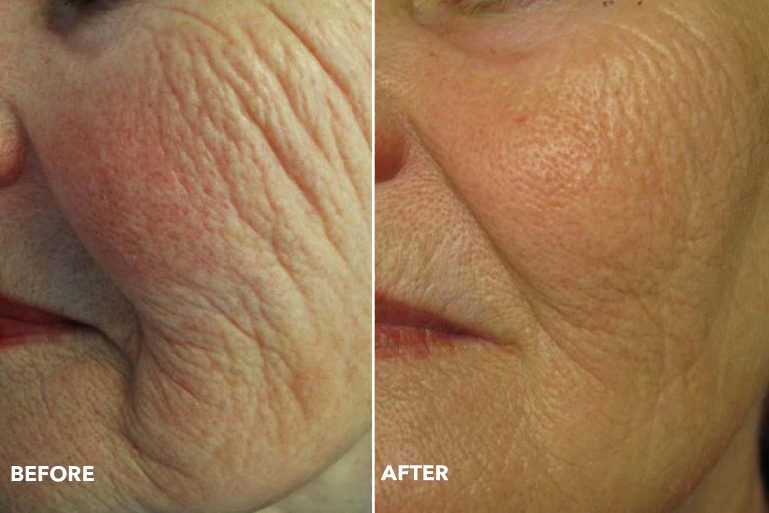 PROFOUND® RF MICRONEEDLING - Vail | Aspen | Basalt | Glenwood Dermatology